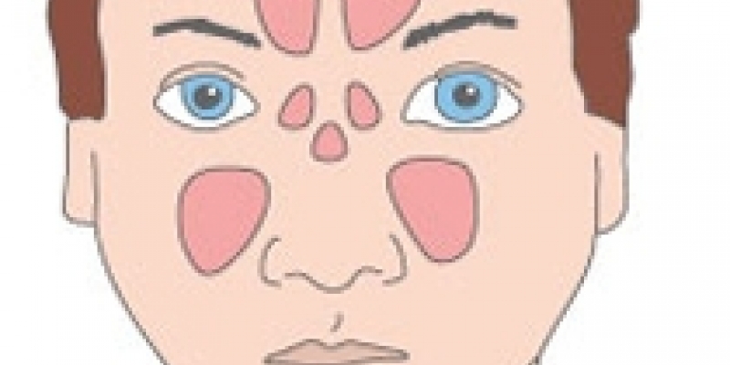 Bihulebetændelse (Sinuitis) - Sundhedsguiden